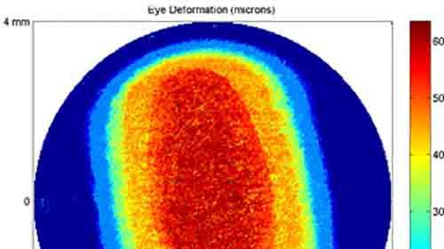 Analyzing LASIK Optical Data Using Zernike Functions - MATLAB & Simulink